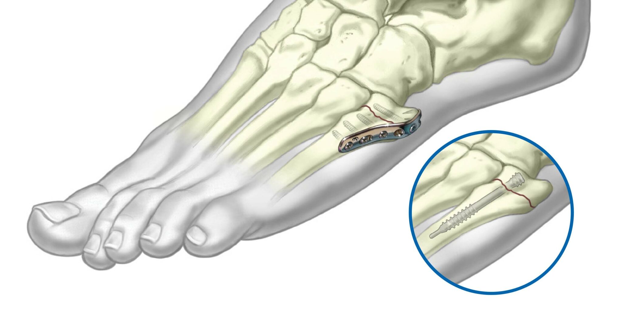 Ankle Fixation System – Ortho Providers