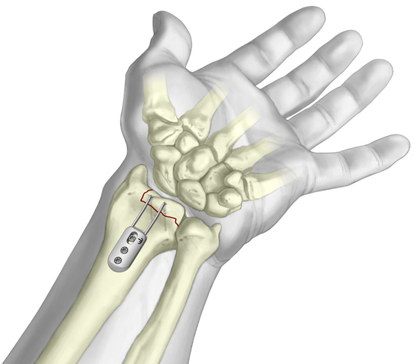 Volar Buttress Pin™ – Ortho Providers