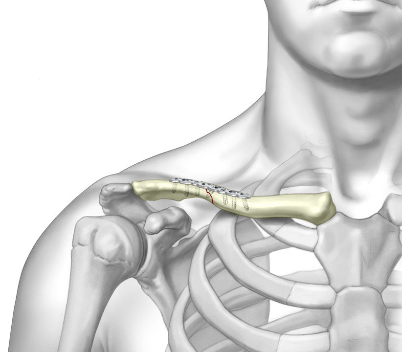 Superior Midshaft Clavicle Plate – Ortho Providers