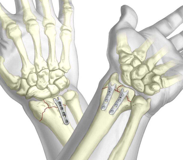 Wrist Hook Plates – Ortho Providers