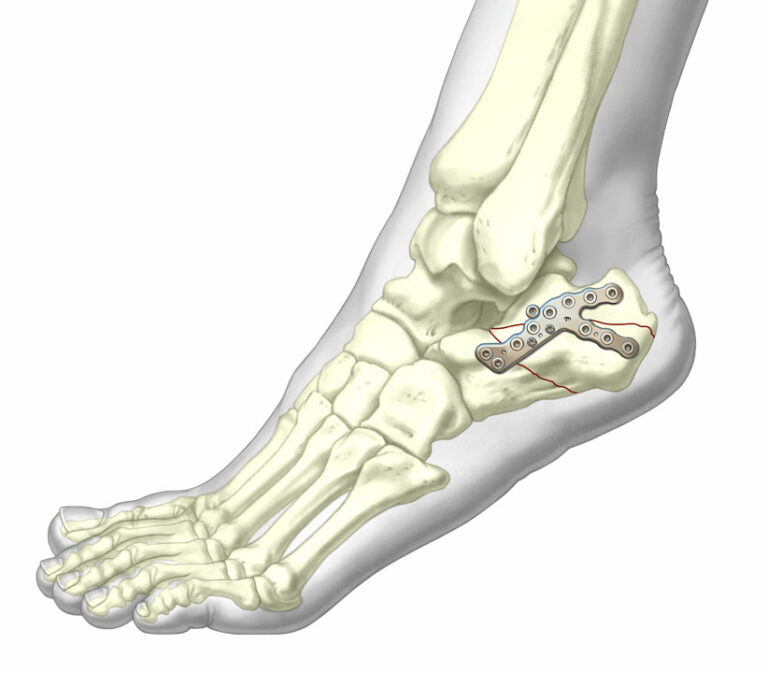 Sinus Tarsi Plate – Ortho Providers