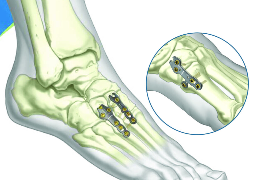 Dorsal Buttress Pin™ – Ortho Providers
