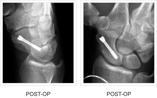 Scaphoid Screw – Ortho Providers