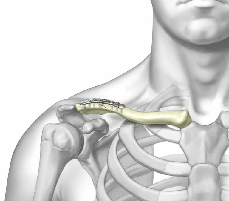 Superior Lateral Clavicle Plate – Ortho Providers