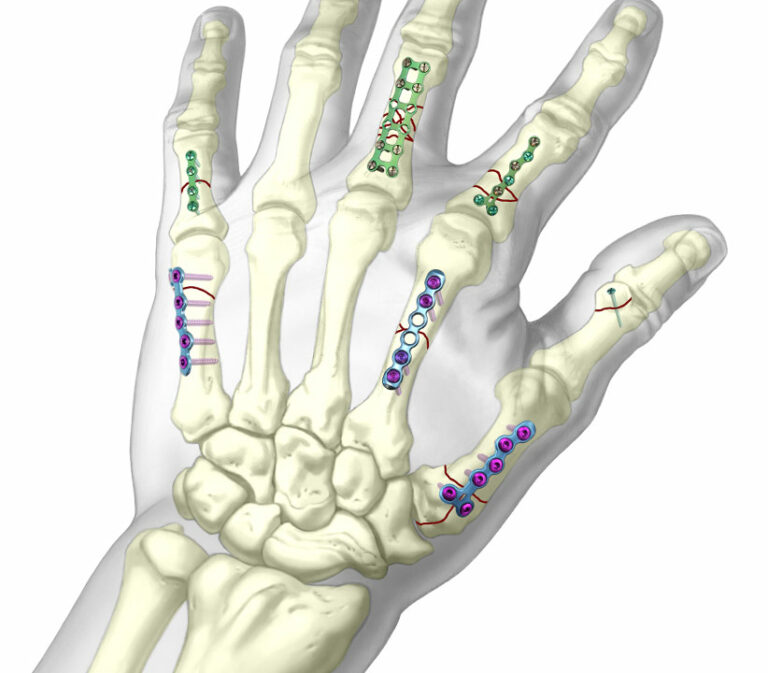 Hand Plates – Ortho Providers