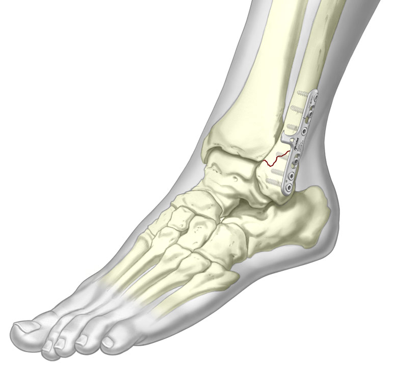 Sidewinder Plate™ – Ortho Providers